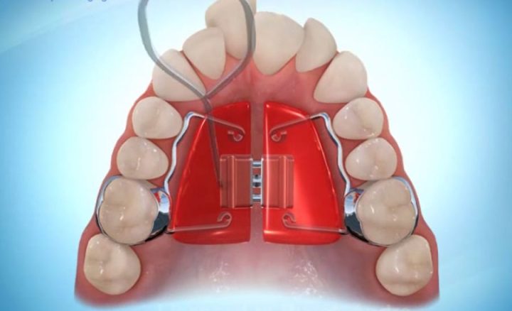 L’appareil d’expansion de type HAAS - Orthodontistes Plus, Dr André Ruest