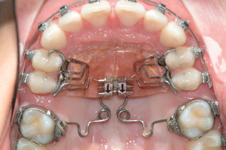 L’appareil de distalisation de type PENDEX - Dr André Ruest